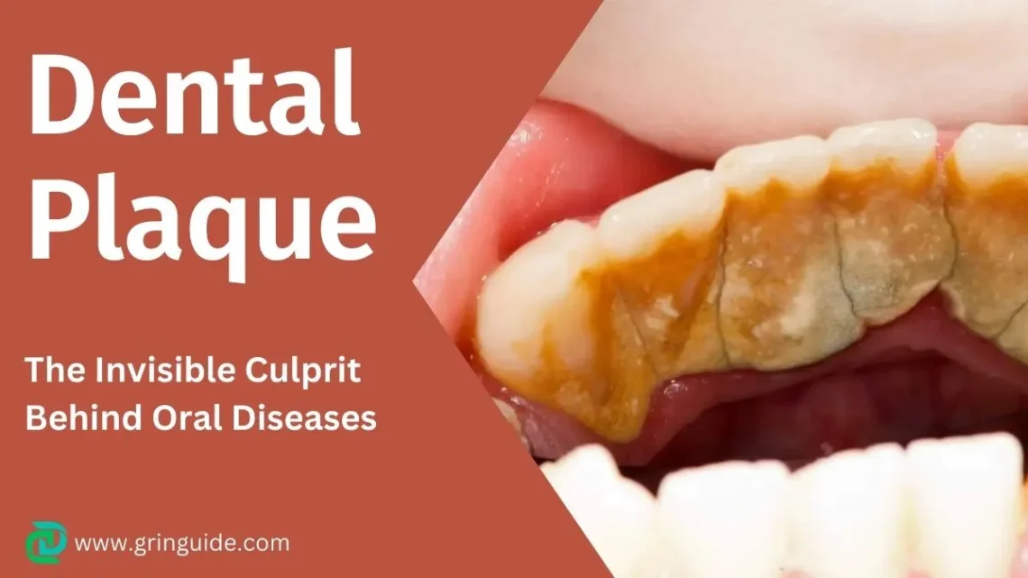 Dental Plaque: The Invisible Culprit Behind Oral Diseases