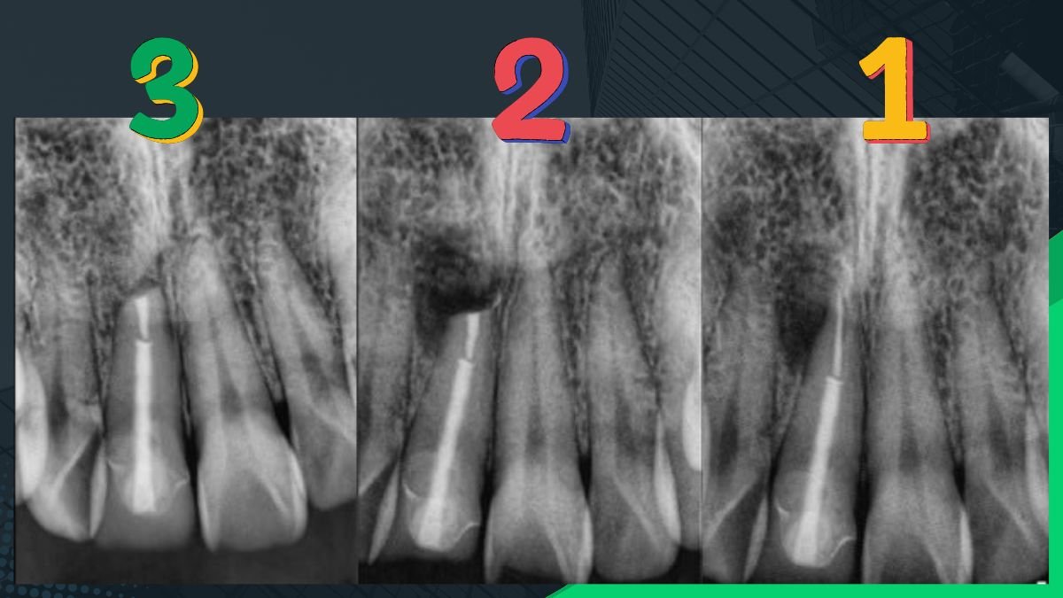 Apicoectomy Success Rate: Dentists reveal the secret 2025