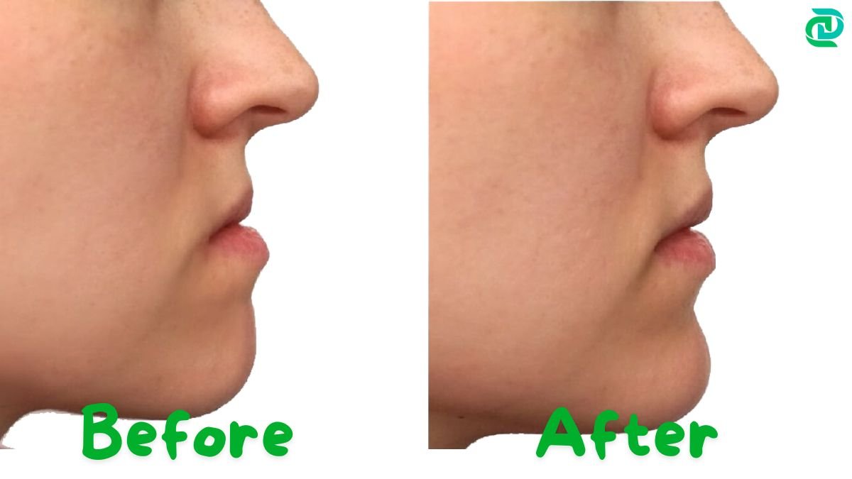 Understanding and Treating Underbites: A Comprehensive Guide